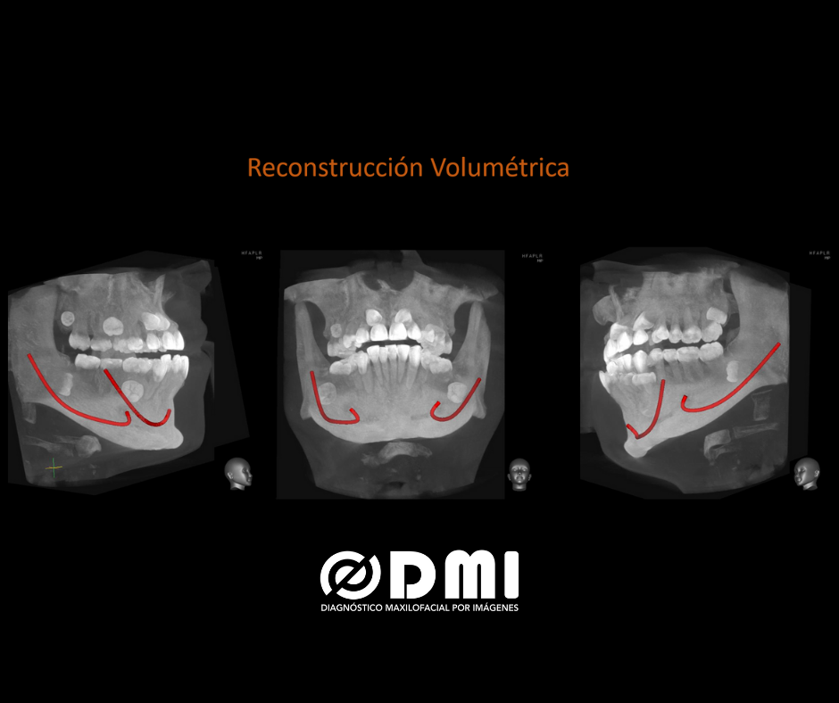 Diagnóstico Maxilofacial por Imágenes: Caso 06 _ Reabsorción radicular ...