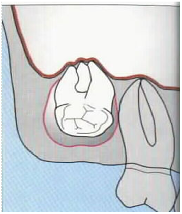 Dentistry and Medicine: Surgical management of Unerupted and Impacted teeth