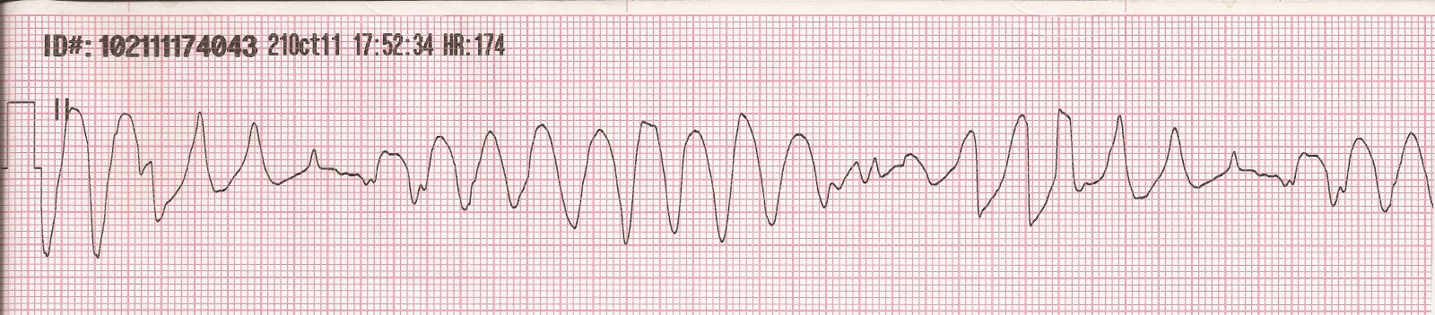 ACLS Rhythms: Ventricular rhythms