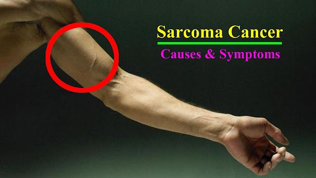 Sarcoma Cancer Facts - Health and Wellness