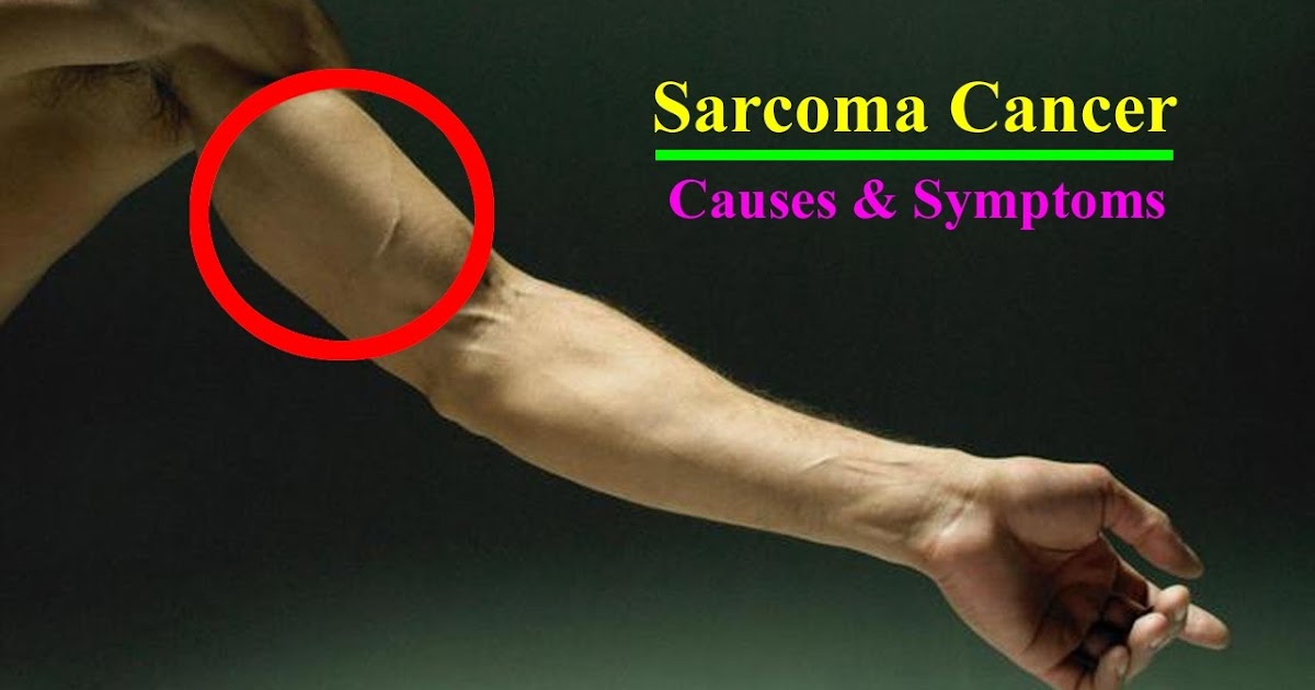 Sarcoma Cancer Facts - Health and Wellness