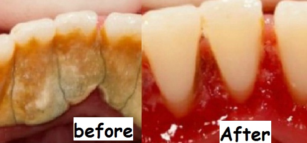 How To Remove Tartar Buildup - my tips favorite