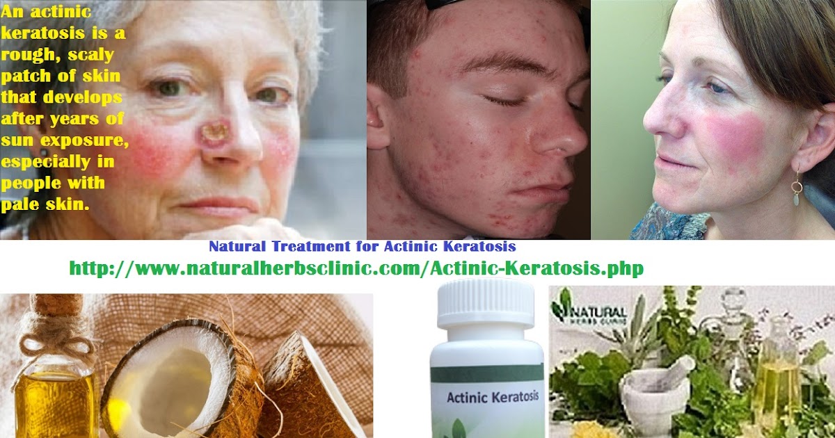 Actinic Keratosis Treatment