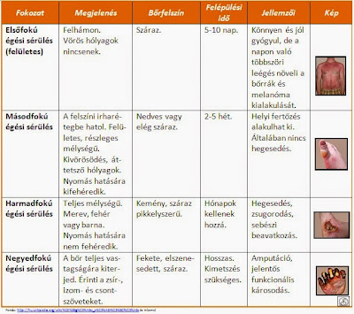 Kreatív blog: Égési sérülések, leégés kezelése