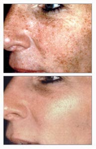Microdermabrasion Before And After | plasticsurgerybeforeandafter