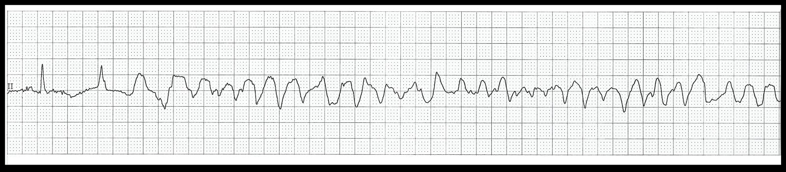 Practice EKG Rhythm Strips 130