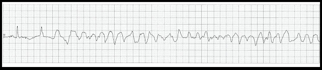 Practice EKG Rhythm Strips 130