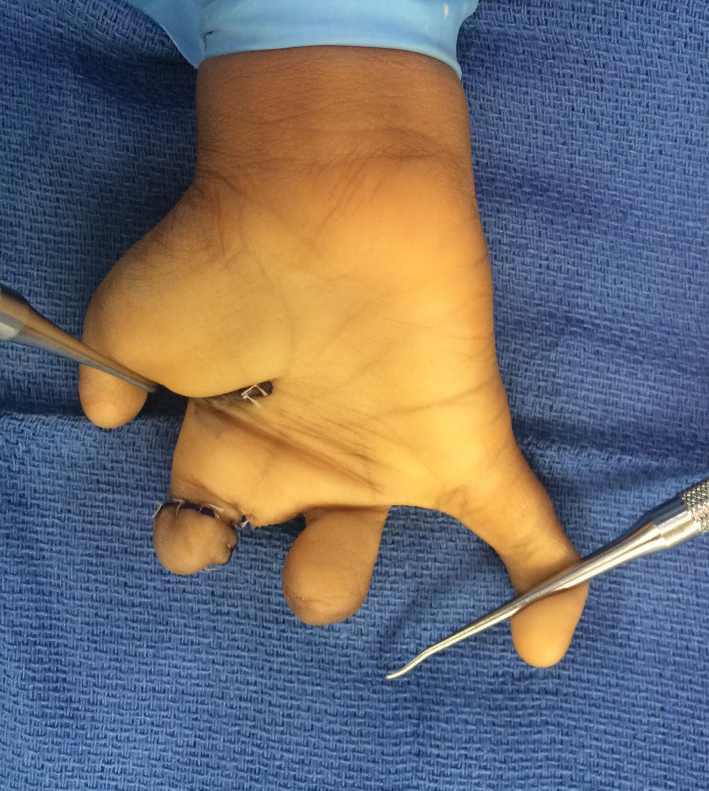 Amniotic Constriction Band | Congenital Hand and Arm Differences ...