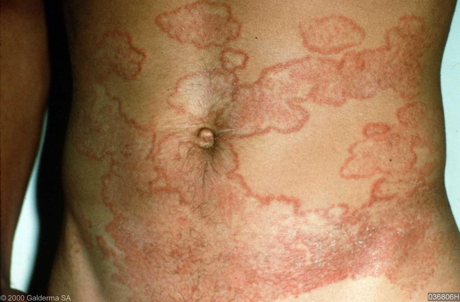 What Is Tinea Corporis? - Teroes
