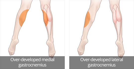 Plastic Surgery in Korea : Calf Reduction Procedure to Solve Complex ...