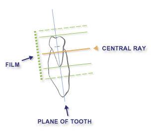 Dentistry and Medicine: Intraoral Radiographic Techniques (Paralleling ...