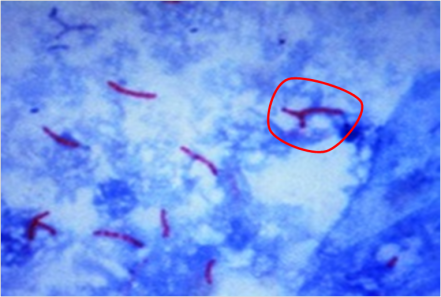 Laboratorium Analis Kesehatan: Prosedur Pewarnaan BTA