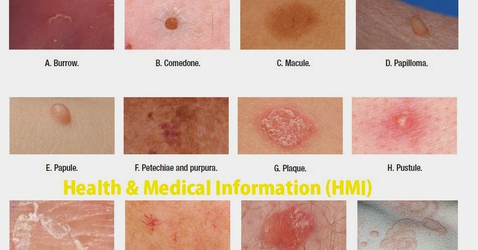 Health and Medical Information (HMI): Terms Used to Describe Skin Lesions