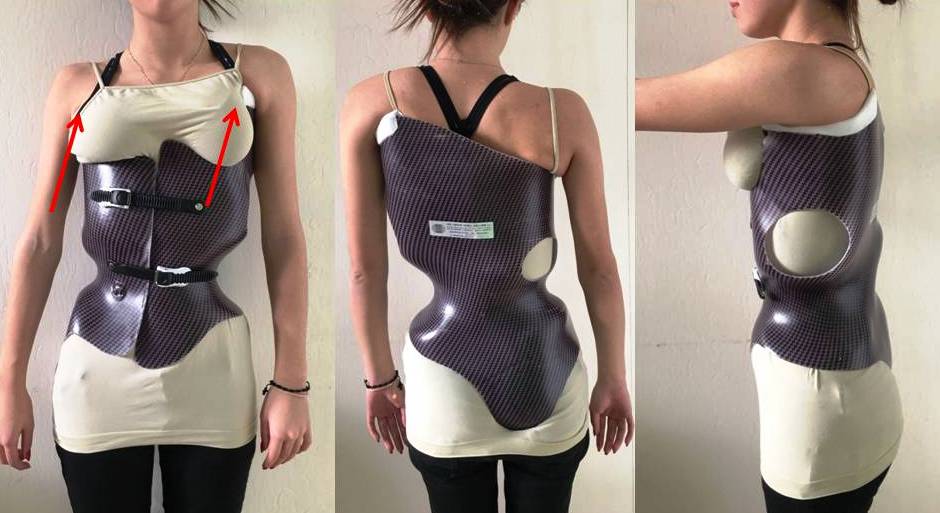 Despre corsetul Cheneau :: Corset scolioza / scoliosis braces