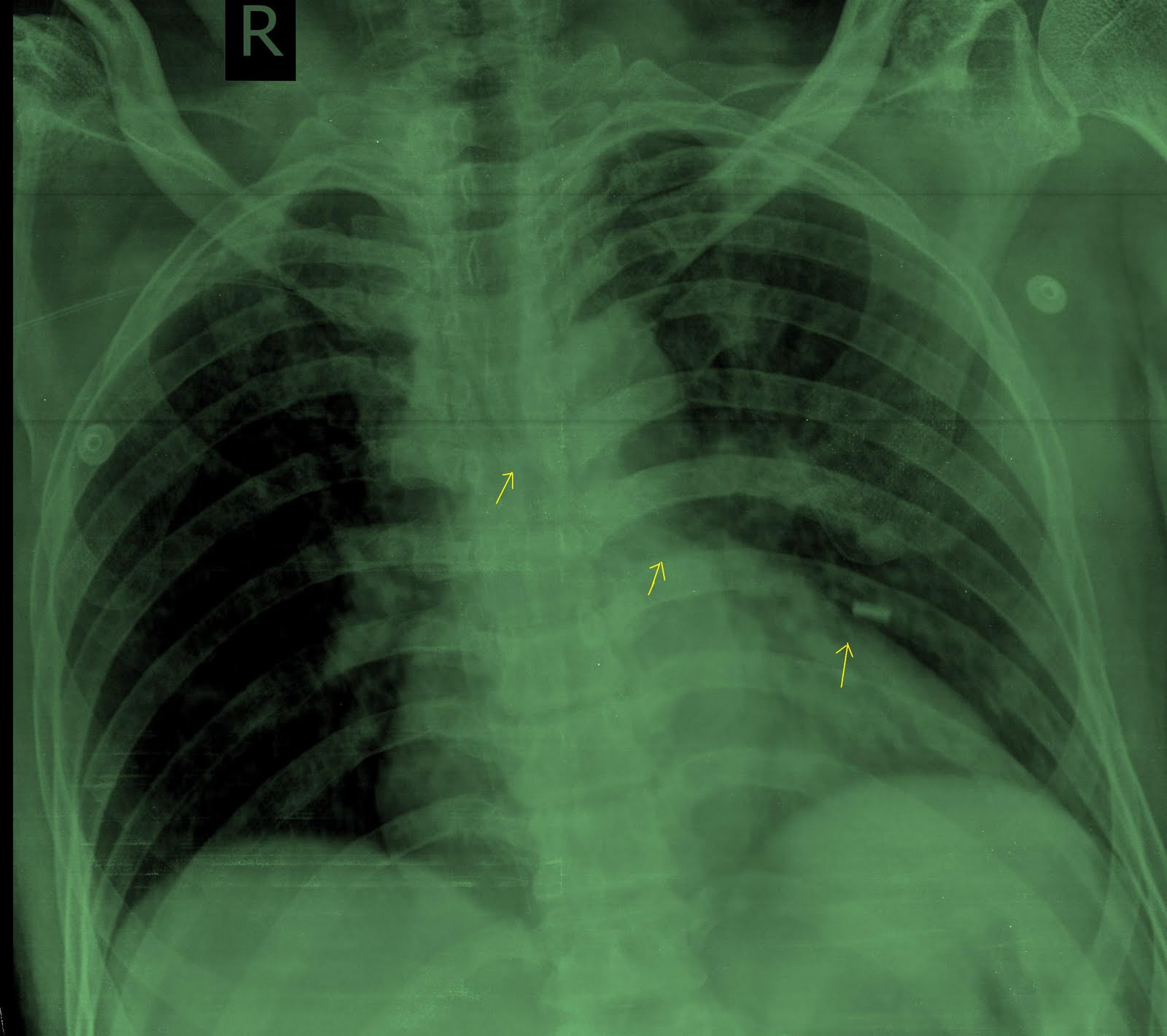 Malpositioned Ryles Tube into Left Bronchus - Sumer's Radiology Blog