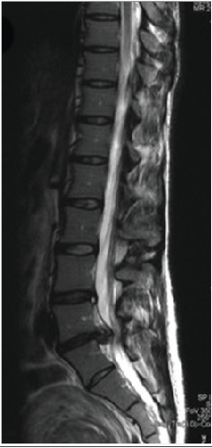 FISIOSENA E A DOR NAS COSTAS: Reabsorção de Hérnia de disco Extrusa.