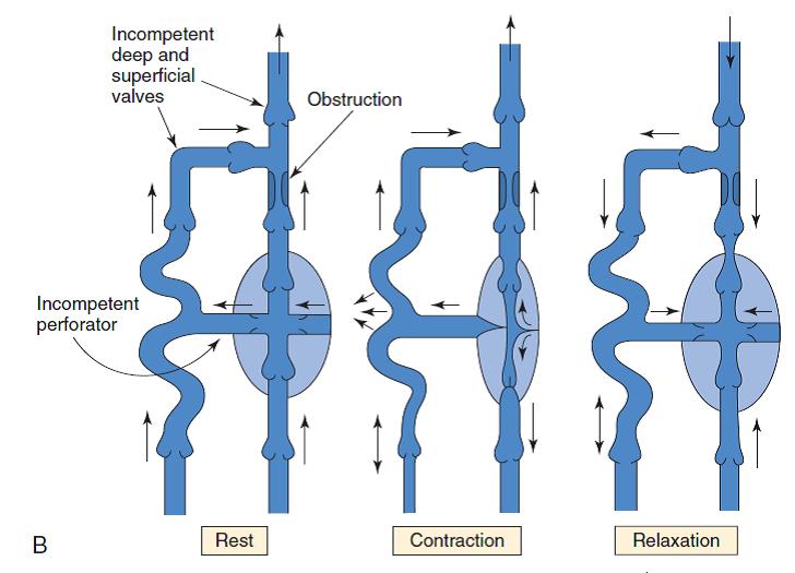 Vascular Mind : DYNAMICS OF VENOUS FLOW IN A NORMAL AND ABNORMAL LIMB