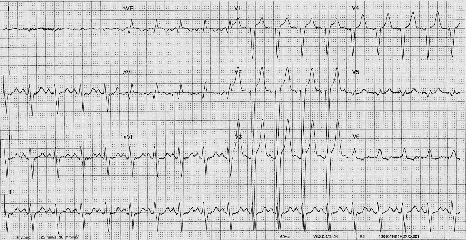 ECG of the Week: ECG of the Week - 21st April 2014 - Interpretation