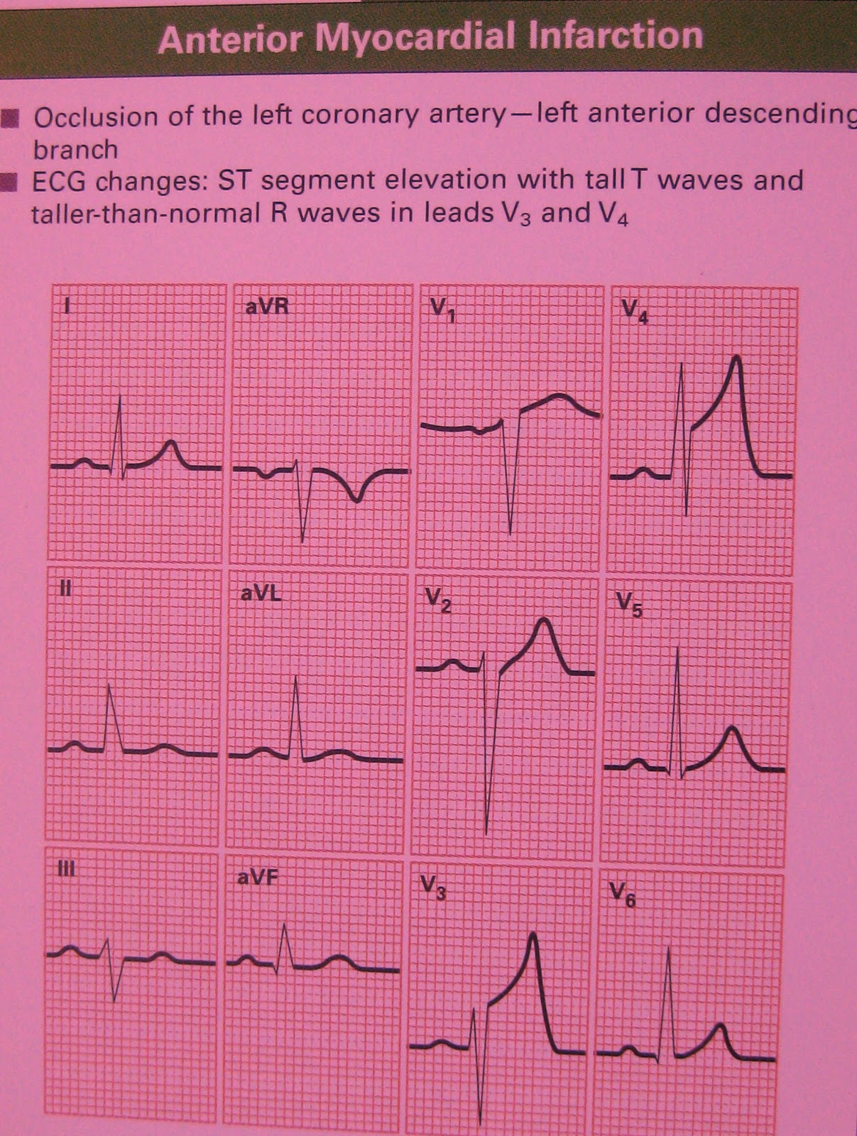 How to read ECG: LOCATION OF MI BY ECG LEADS