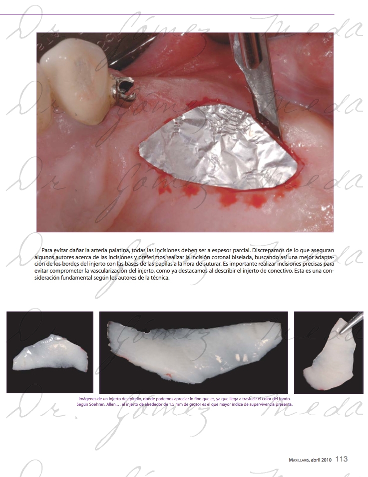 Dr.Meda: Injerto Epitelial Libre: Control de la Estabilidad a Largo ...