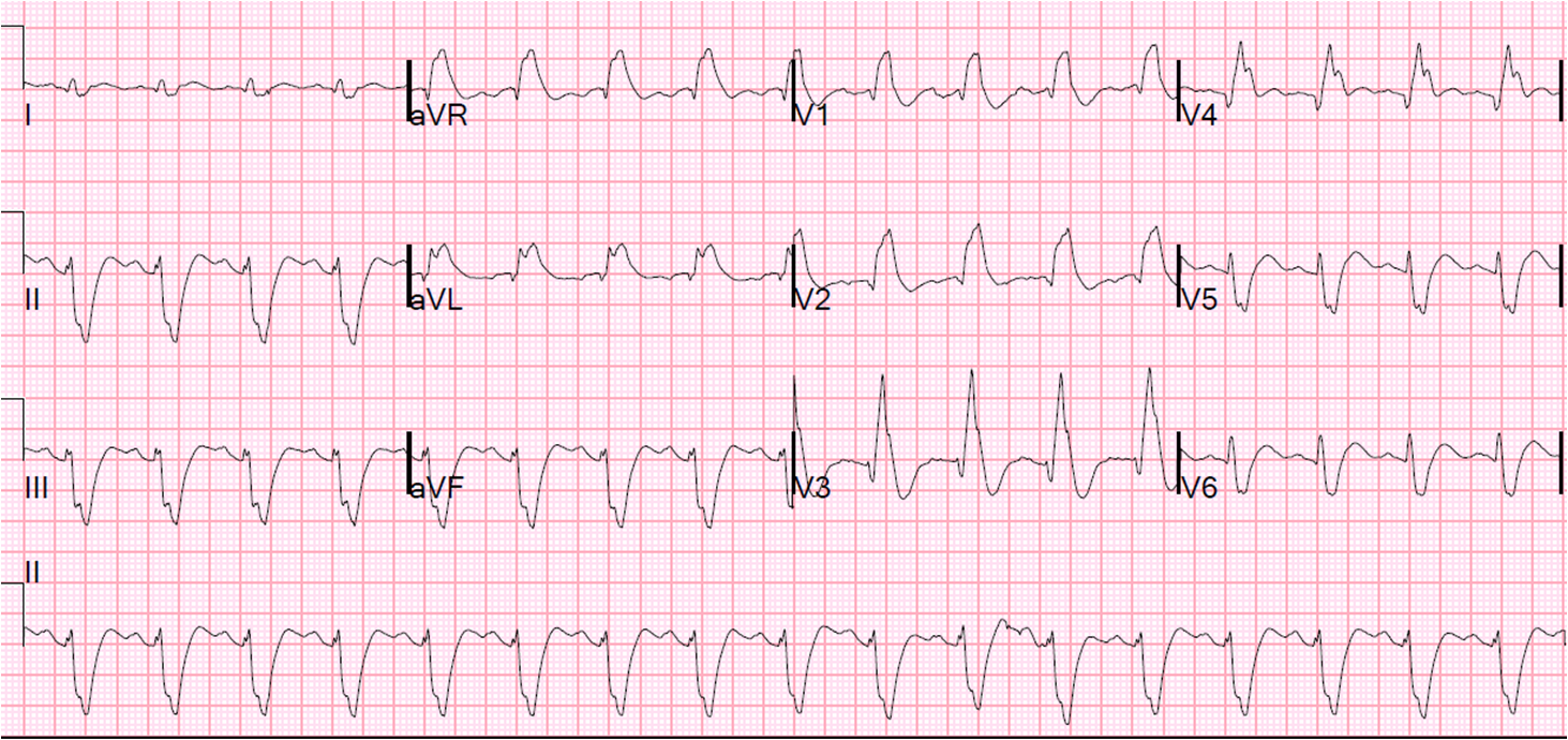 Dr. Smith's ECG Blog: 68 minutes with chest compressions, full recovery ...