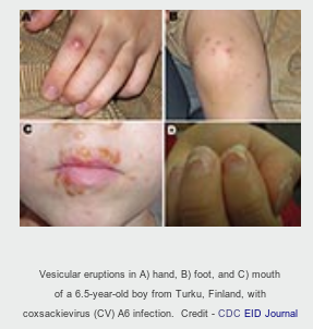 Avian Flu Diary: HK CHP Urges Heightened Vigilance As EV71 Cases Rise