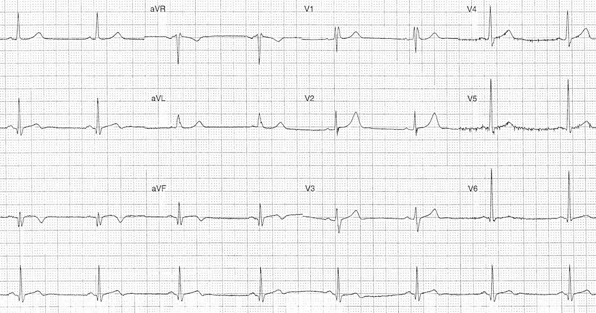 ECG of the Week: ECG of the Week - 3rd December 2018 - Interpretation