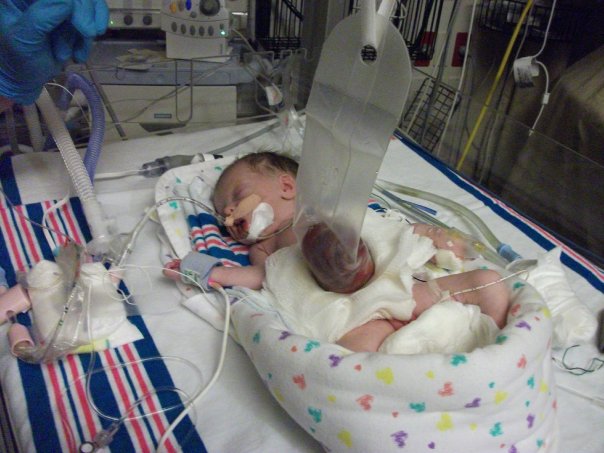 Gastroschisis Awareness