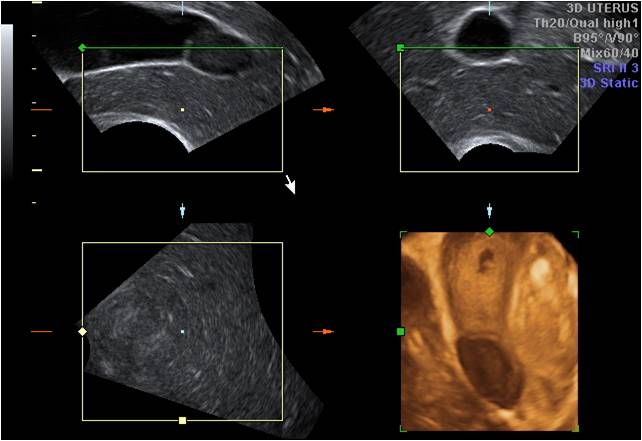 Gall Bladder Wall Cyst [ Possibly Submucous Cyst ]: An Ultrasound ...