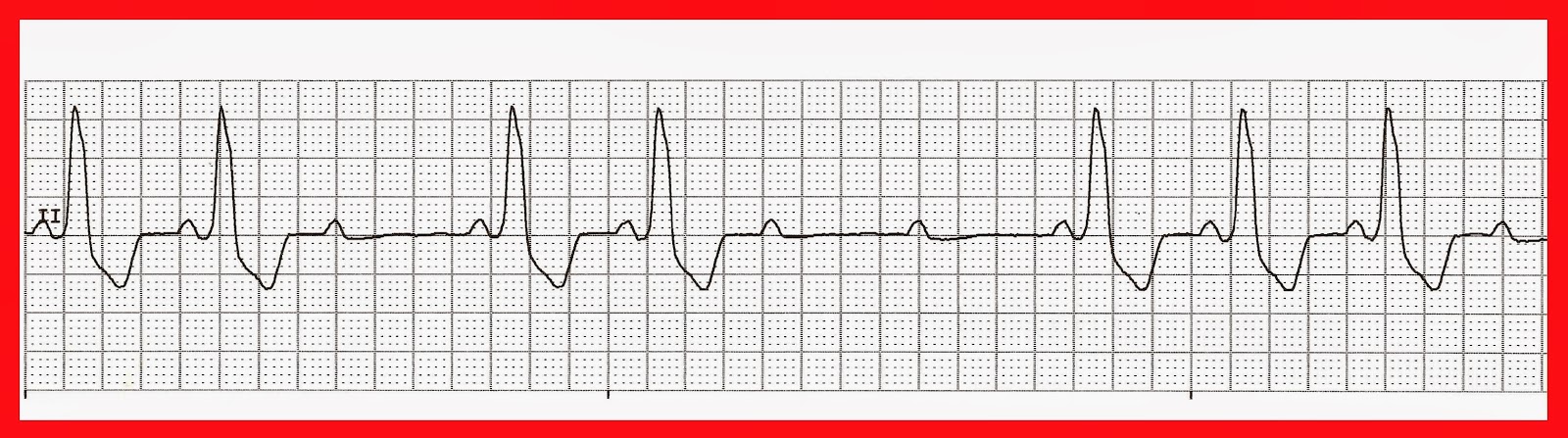 Basic EKG Rhythm Test 21 (Heart Block Challenge)