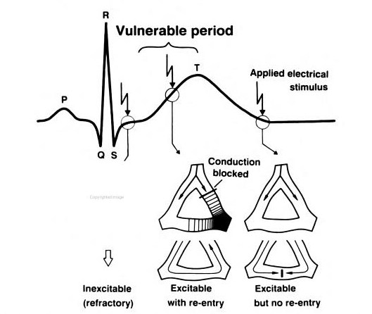 My Variables Only Have 6 Letters: Synchronized Cardioversion: What ...