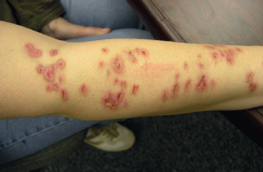 Síndrome De Ekbom - Doença Conhecida Como Delírio De Parasitose - Saúde ...