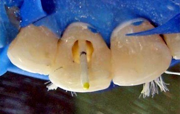 Postes de fibra vs. perno muñon colado