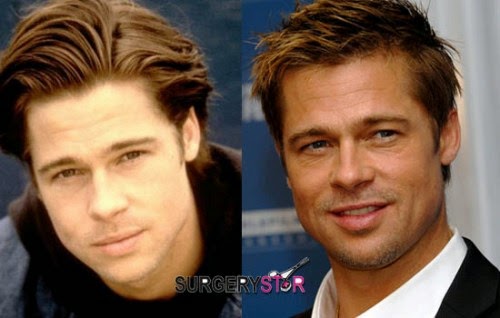 Brad Pitt Botox and Facial Fillers Plastic Surgery Before and After