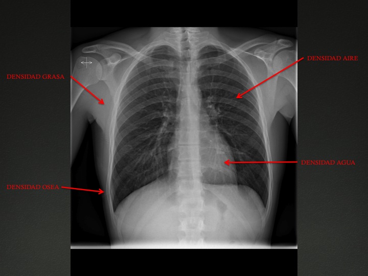 RADIOLOGIA LLEIDA: RADIOGRAFIA DE TORAX (I): Introducción, densidades y ...