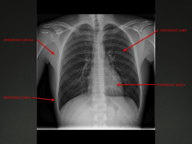 RADIOLOGIA LLEIDA: RADIOGRAFIA DE TORAX (I): Introducción, densidades y ...