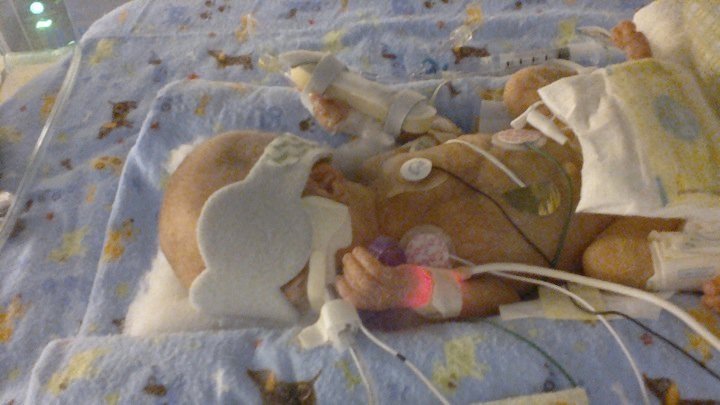 Frog In Stitches: Avoiding NICU head aka Plagiocephaly