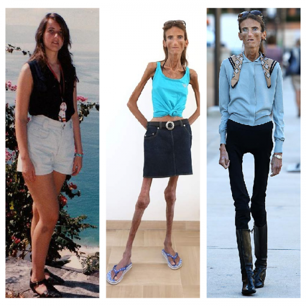 A mulher com anorexia mais grave do mundo - Noticias G35