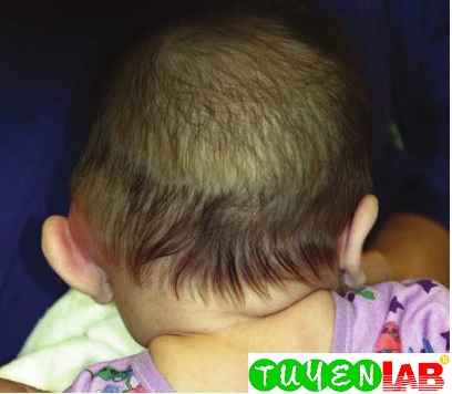 [Pediatric] Atlas of Mastoiditis | Free Medical Atlas