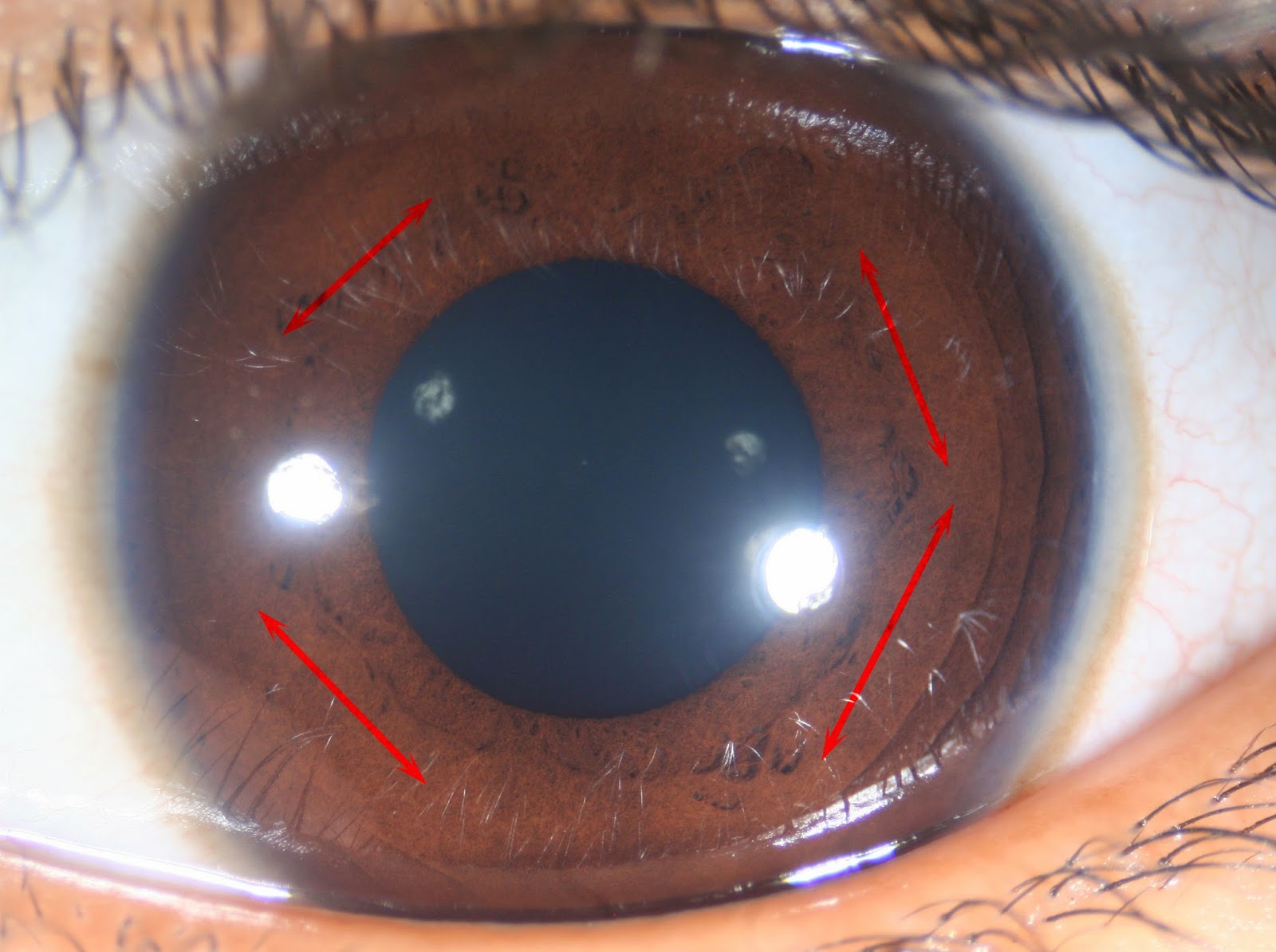 Modern & Multidimensional Iridology: Multiple Linear Collarette ...