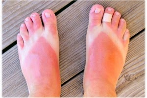 TIPS MENGATASI KULIT TERBAKAR