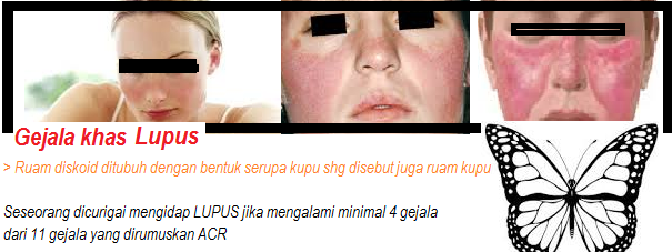 Lupus dan Cara Pengobatannya | Sehat dan Gaul