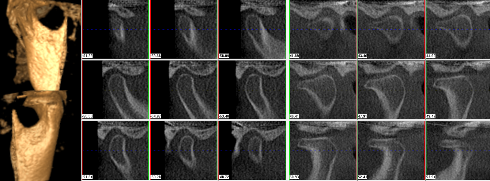 DrChetDMD: Unilateral Condylar Hyperplasia