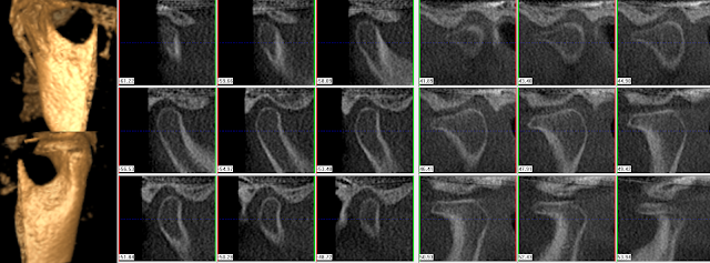 DrChetDMD: Unilateral Condylar Hyperplasia