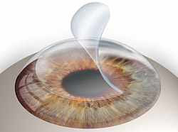 Surgery Made Easy: How is Lasik Performed