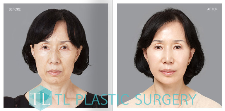 TLlifting_Singapore: Facelift Surgery Rhytidectomy