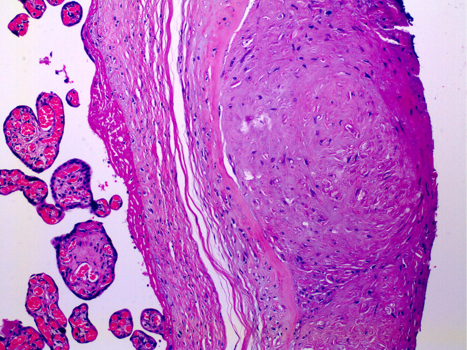 Histopatologando - Atlas do HCFMRP-USP: Âmnio nodoso