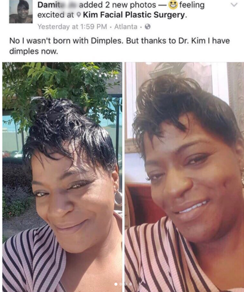 Latest Updates: The new craze ! Ladies are getting artificial dimples ...