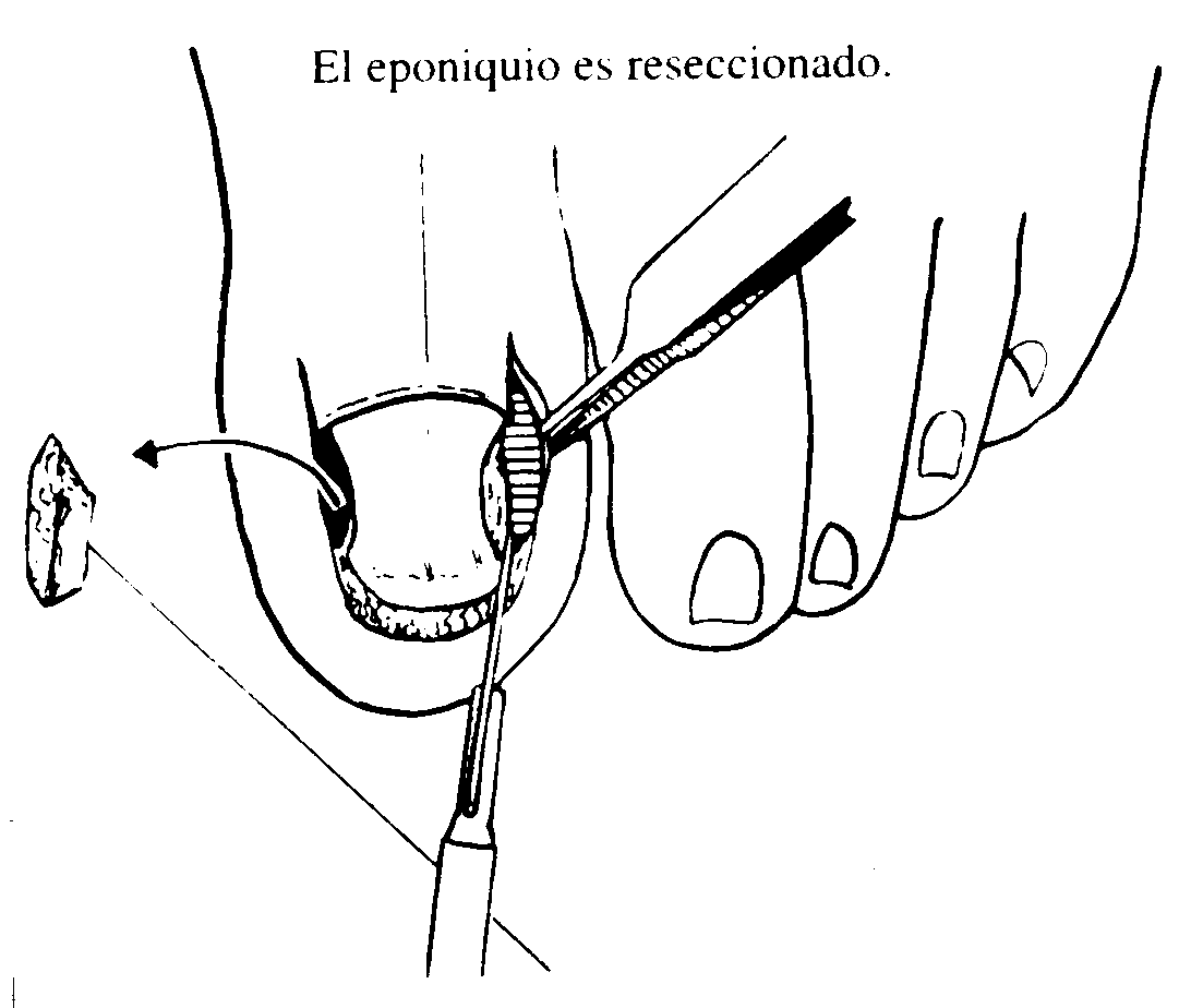 es: Onicocriptosis o Uña Encarnada