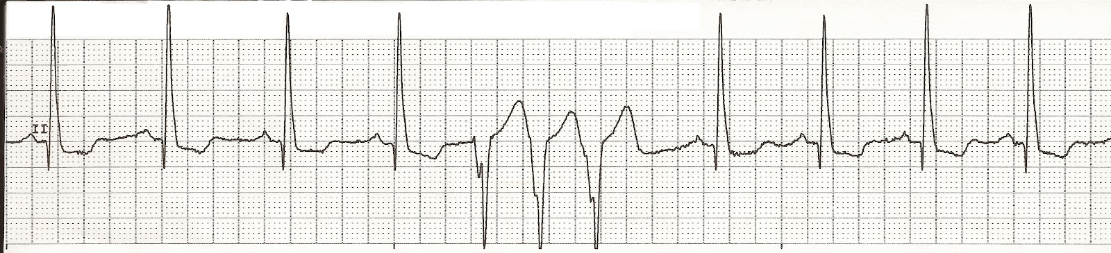 EKG Rhythm Strip Quiz 49